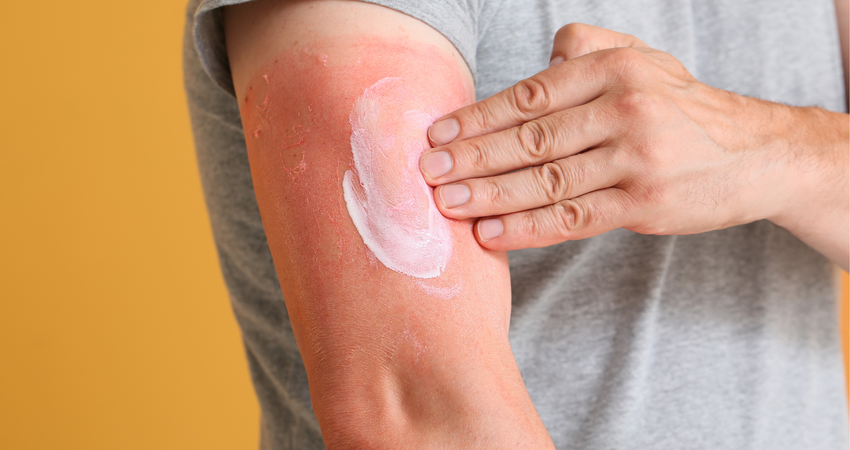 How to Treat Sunburn – Australian Medical Solutions